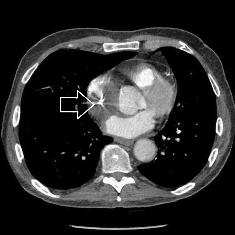 Cardiac Involvement of Myeloid Sarcoma | Society for Cardiovascular ...