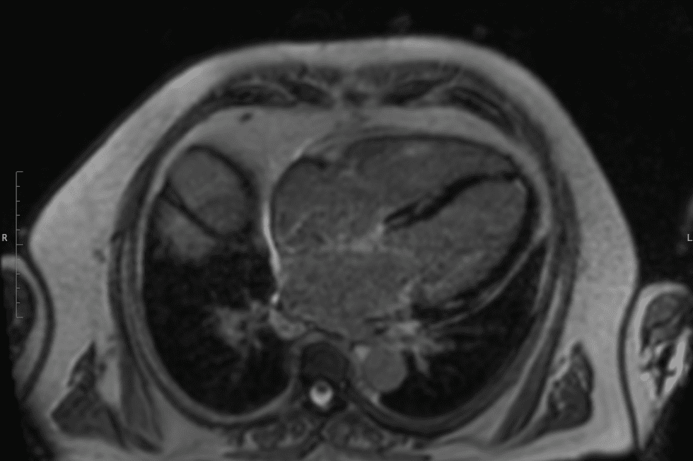 The Utility of Cardiac MRI In Cardiac Sarcoid | Society for Cardiovascular Magnetic Resonance