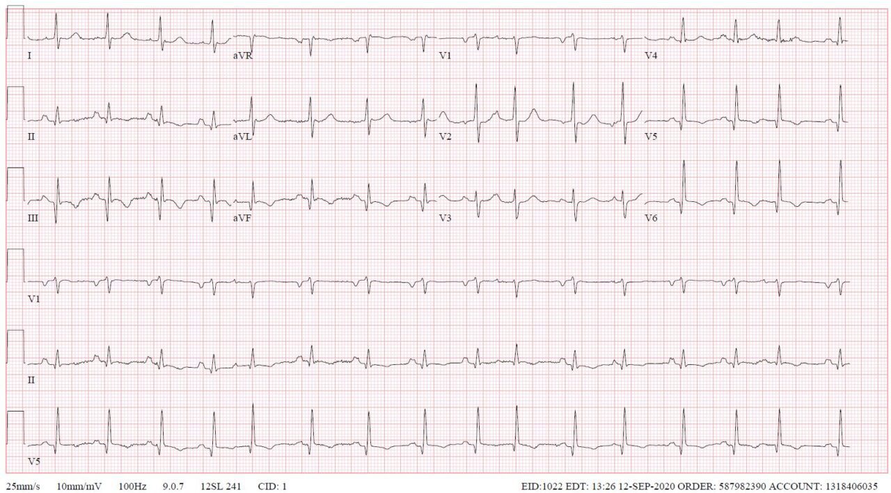 Newly developed heart failure: What is the Etiology? | Society for ...