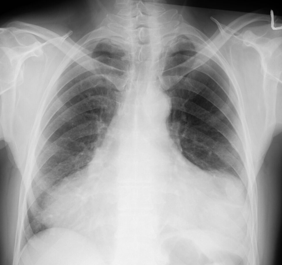 Pericardial hydatid cyst with pericoronary involvement and large ...